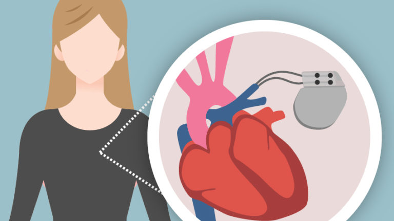 Living Well with your Implantable Cardioverter Defibrillator (ICD)